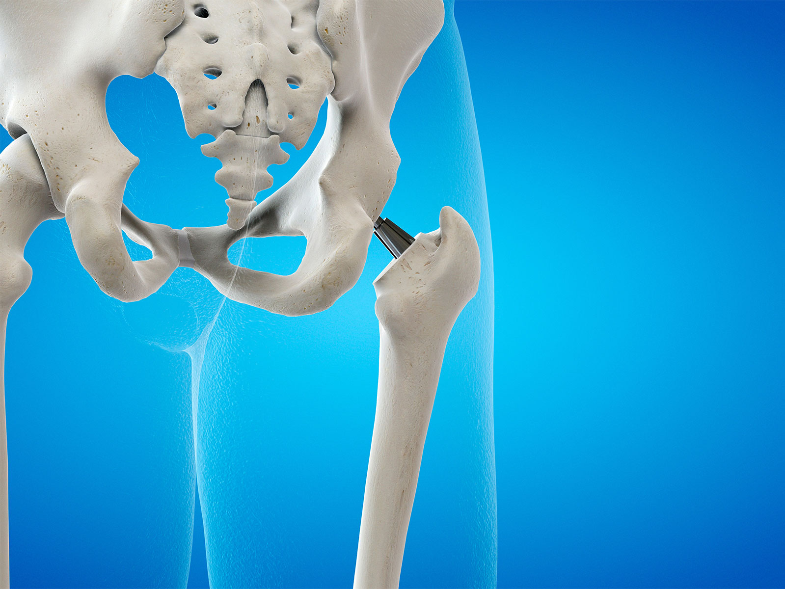 What are Hip Replacements Made of? - Kley Rapid Hip