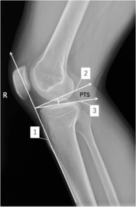 Posterior Tibial Slope and ACL Failure: Understanding a Key Risk Factor
